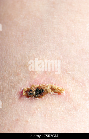 Human arm with bite mark Stock Photo - Alamy