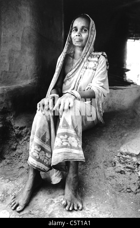 Leper woman ( India Stock Photo - Alamy