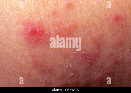 Eczema atopic dermatitis symptom skin texture Stock Photo - Alamy