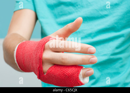 Broken hand in plaster cast with bandages, red, swollen fingers after ...