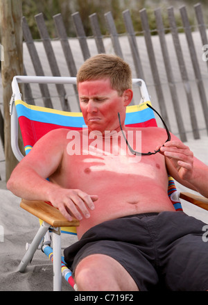 A model looks to be badly sunburned after falling asleep on the beach ...