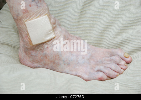 Elderly woman with Mepilex borderlite iodine dressing / plaster to keep ...