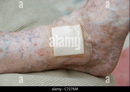 Elderly woman with Mepilex borderlite iodine dressing / plaster to keep ...