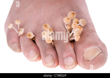 MYCOSIS ON A FOOT Stock Photo - Alamy