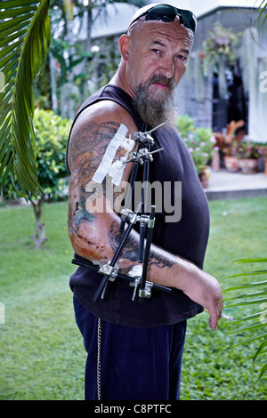 Man with an external fixator application for broken arm damage Stock ...