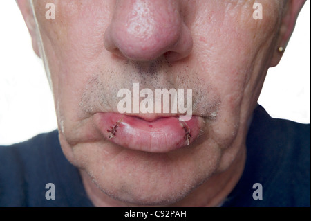 man with stitches in lower lip after having biopsy Stock Photo ...