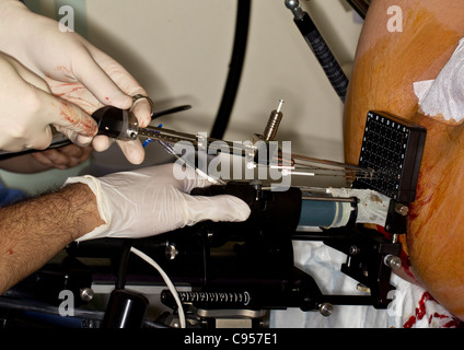 A Mick applicator being used to implant radioiodine seeds into a ...
