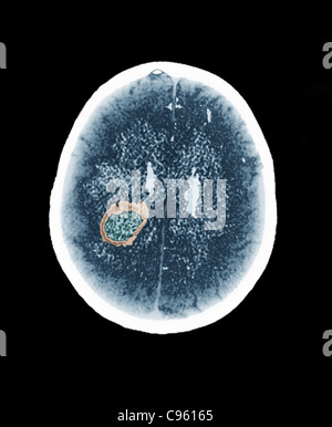 Brain abscess, CT scan Stock Photo - Alamy