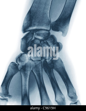 X-ray of both human arms (normal arms and arms with splint Stock Photo ...