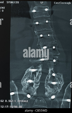 magnetic resonance imaging of the spine Stock Photo - Alamy