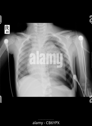 Coloured chest X-ray of the lung of a patient with valley fever, or ...
