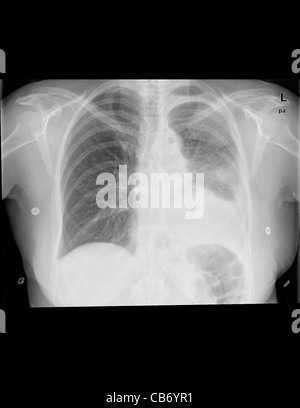 Coloured chest X-ray of the lung of a patient with valley fever, or ...