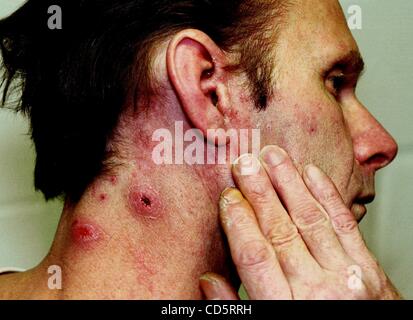 Mar. 15, 2003 - Huntsville, Alabama, U.S. - An HIV infected inmate's ...