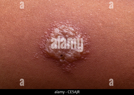 TUBERCULIN SKIN TEST Stock Photo - Alamy