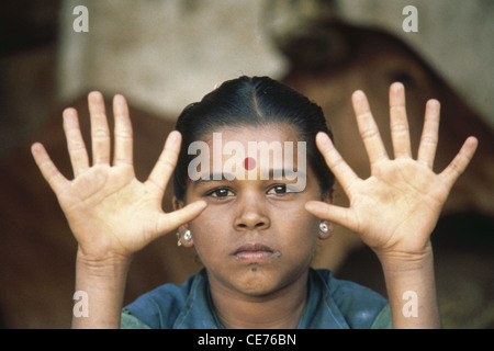 Hexadactyly ; Indian girl with six fingers in hands ; congenital ...