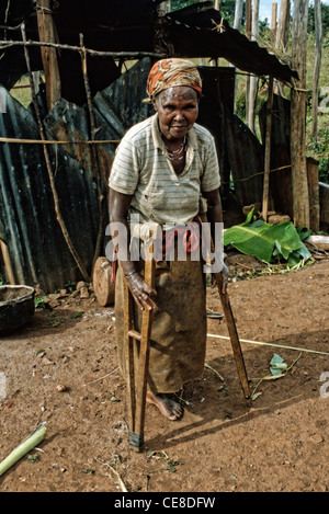 A woman who lost one leg to Chondrosarcoma, a cartilage-based tumor ...