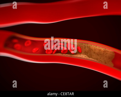 Narrowed artery. Computer artwork of an artery that is partially ...