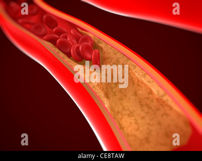 Narrowed artery. Computer artwork of an artery that is partially ...