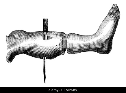 Amputation of the leg by the method has two flaps (circular incision ...