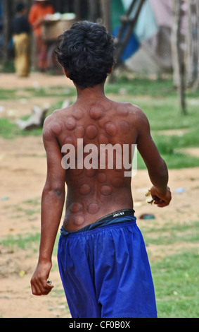 A boy who has undergone tradition cupping therapy in Kompong Phluk ...