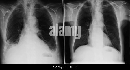 Chest X-Ray of Normal male patient high quality image showing normal ...