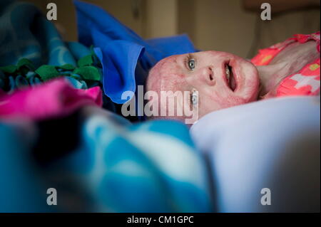 Burn survivor, Isabella "Pippie" Kruger is comforted by her mother ...
