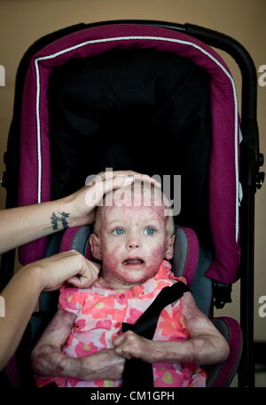 Burn survivor, Isabella "Pippie" Kruger is comforted by her mother ...
