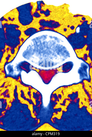 HERNIATED DISK, SCAN Stock Photo - Alamy