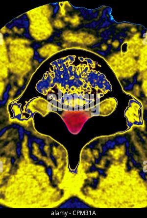 HERNIATED DISK, SCAN Stock Photo - Alamy