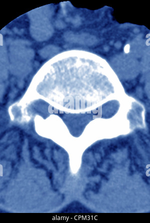 HERNIATED DISK, SCAN Stock Photo - Alamy