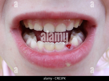Child With Milk Tooth And Gaps Between The Teeth Tooth Teeth Tooth