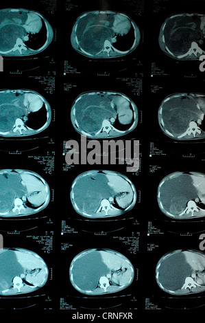 Radiology. CT scan showing a blood pooling on the right side of a ...