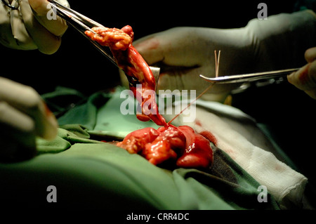 Removal of tissue during surgery Stock Photo - Alamy