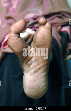 Close up of a left foot with second, third and fourth toes amputated ...