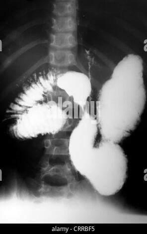 Barium contrast X-ray of the abdomen Stock Photo - Alamy