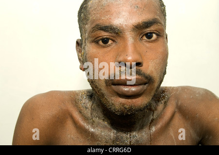 A patient with severe, extensive psoriasis all over their body Stock ...