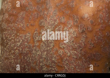 A patient with severe, extensive psoriasis all over their body Stock ...