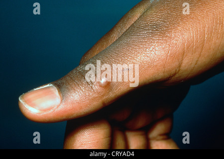 TOXIC BULLOUS DERMATOSIS Stock Photo - Alamy