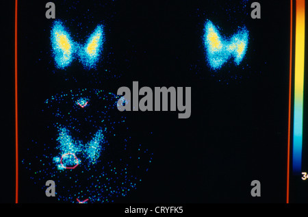 THYROID GLAND, SCINTISCAN Stock Photo - Alamy