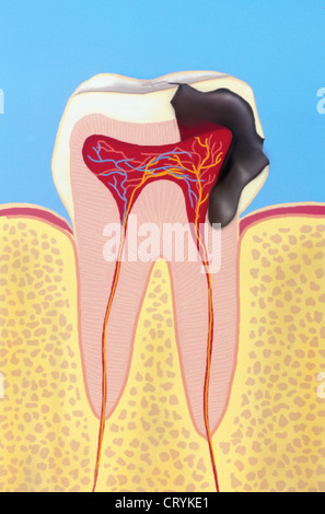 DENTAL CARIE, DRAWING Stock Photo: 49293613 - Alamy