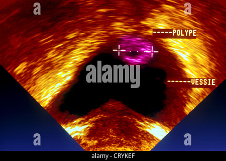 BENIGN TUMOR OF THE BLADDER Stock Photo: 66576568 - Alamy