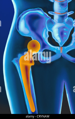 HIP PROSTHESIS, DRAWING Stock Photo - Alamy