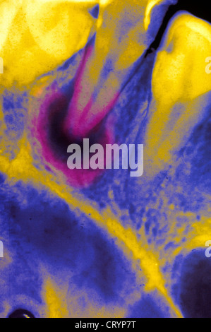 DENTAL ABSCESS, X-RAY Stock Photo - Alamy