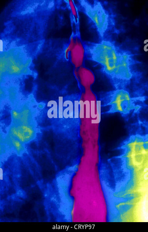 ESOPHAGEAL VARIX, X-RAY Stock Photo - Alamy