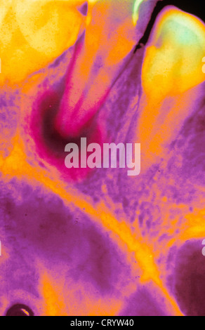 DENTAL ABSCESS, X-RAY Stock Photo - Alamy