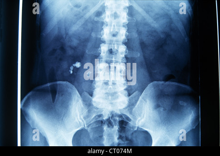 X-ray - kidney stones Stock Photo - Alamy