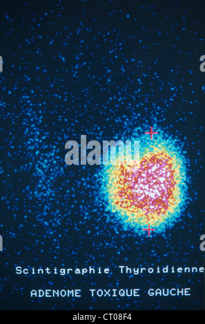 THYROID GLAND, SCINTISCAN Stock Photo - Alamy