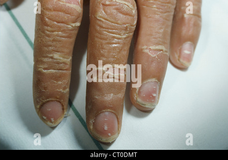 DESQUAMATION OF THE SKIN Stock Photo: 49183258 - Alamy