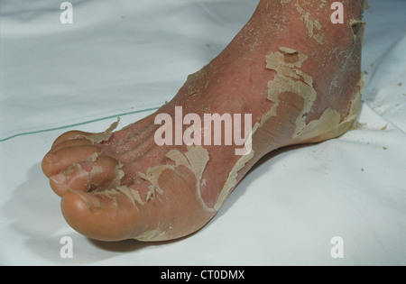 DESQUAMATION OF THE SKIN Stock Photo - Alamy