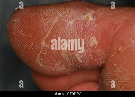 DESQUAMATION OF THE SKIN Stock Photo - Alamy
